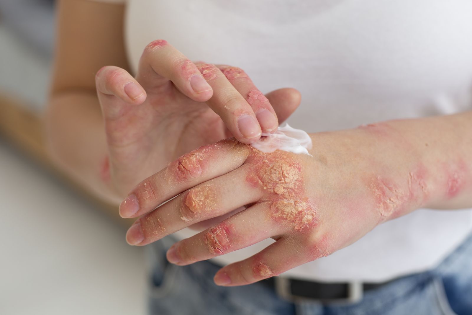 Psoriasis Unveiled: Understanding Thick and Scaly Skin :: Fitie :: Articles
